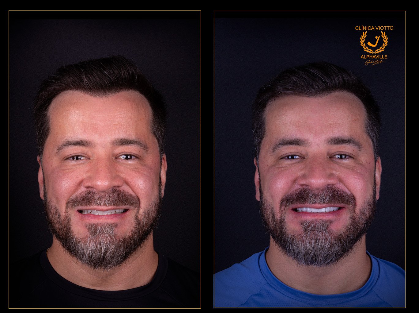 Endodontia (tratamento de canal) - Dr. Gabriel Lembo